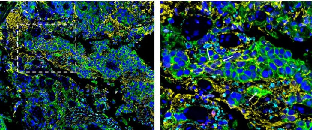 Neural Hijack: How Lung Cancer Rewires Itself to Spread to the Brain ...
