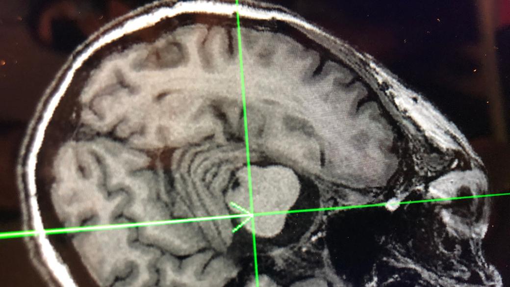 Brain Tumor Research | Herbert Irving Comprehensive Cancer Center ...