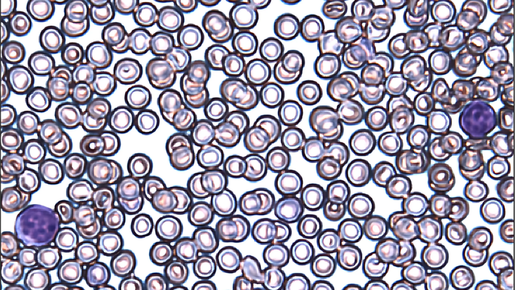 Azra Raza, MD | Herbert Irving Comprehensive Cancer Center (HICCC ...