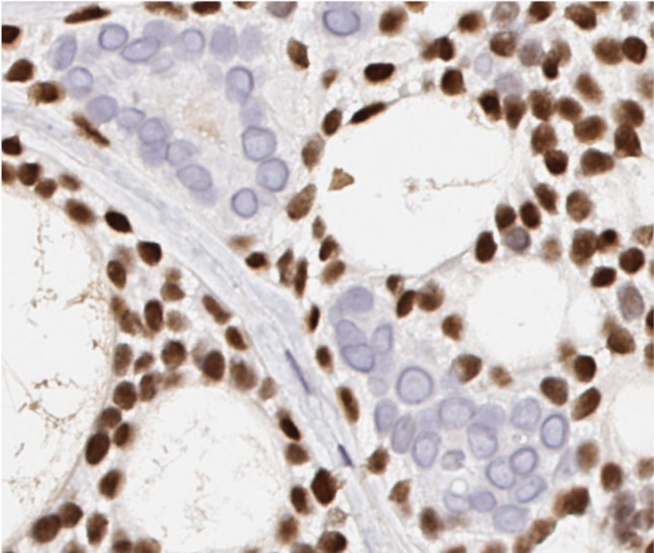 New Discovery Could Stop a Rare Cancer in Its Tracks | Herbert Irving ...