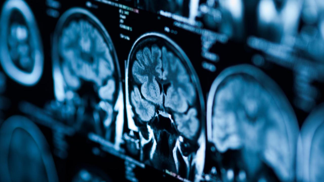 Precision Therapy for Brain Cancer Shows Promise in Some Patients ...