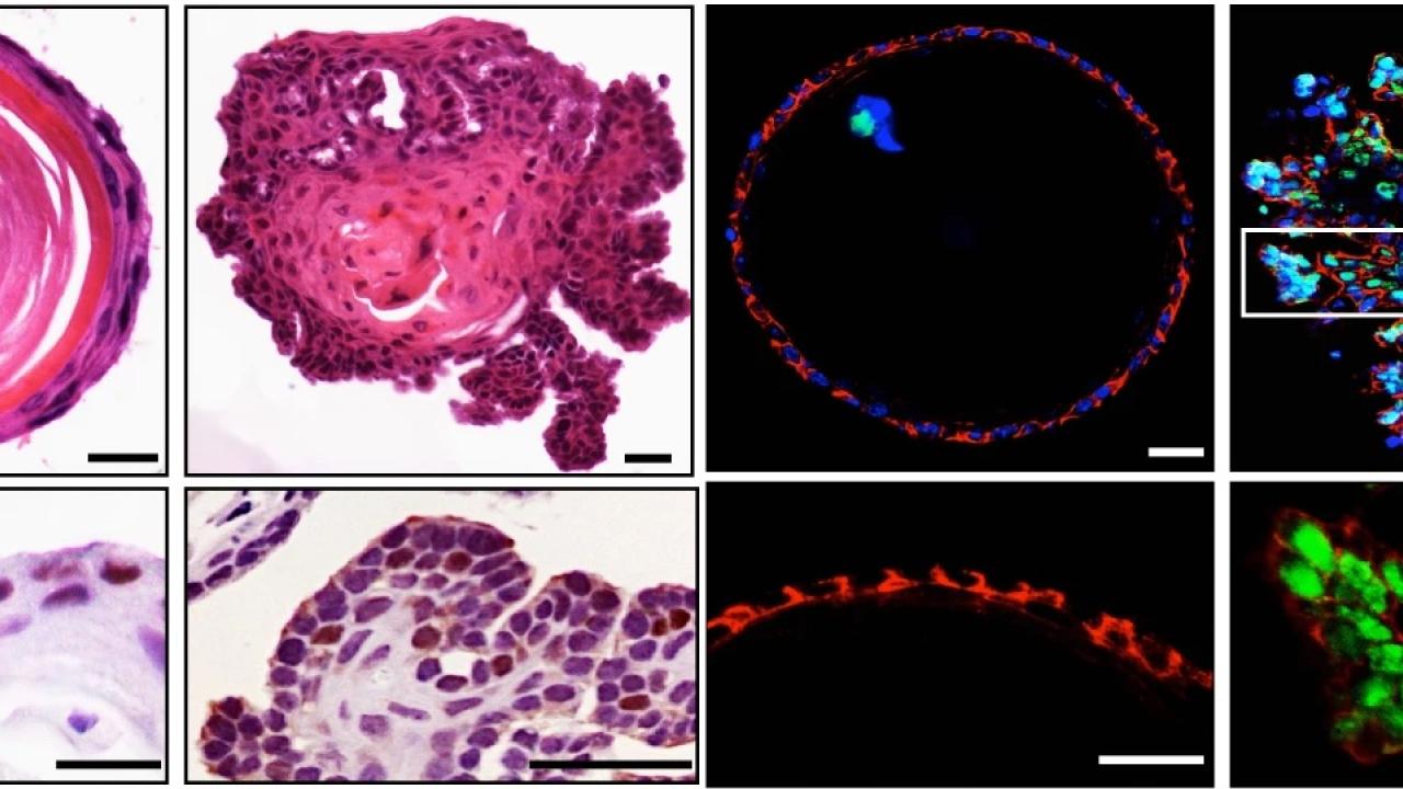 Using Patient-Derived Organoids, Oncologists Can Predict a Tumor’s ...