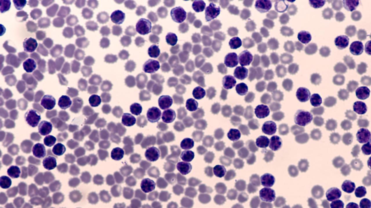 Key Advances in Targeted Therapy for Chronic Lymphocytic Leukemia: Q+A ...