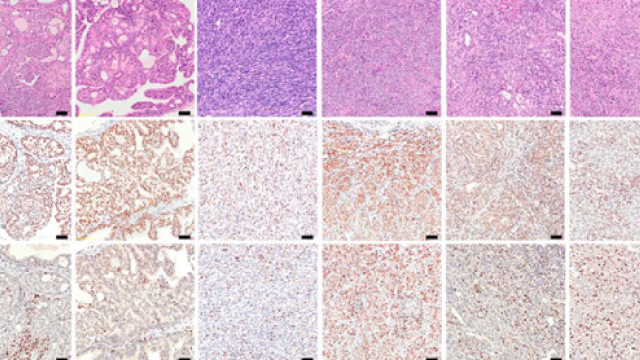 Precision Medicine Sends Cancer for a Loop | Herbert Irving ...