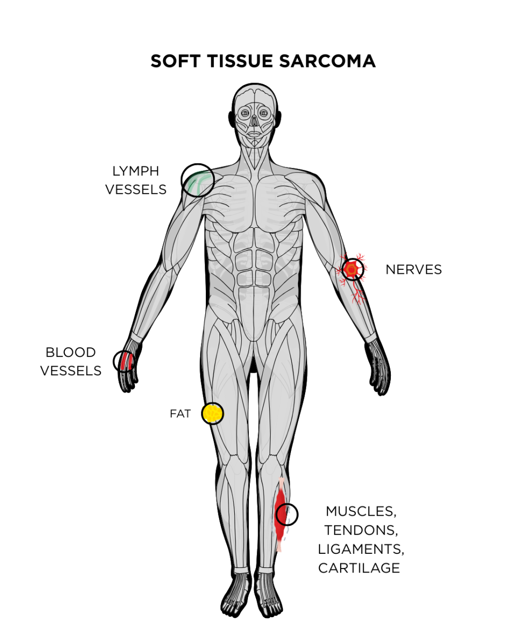 Sarcoma Types | Herbert Irving Comprehensive Cancer Center (HICCC ...