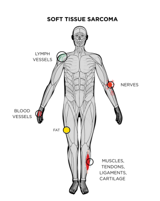 Sarcoma Types | Herbert Irving Comprehensive Cancer Center (HICCC ...
