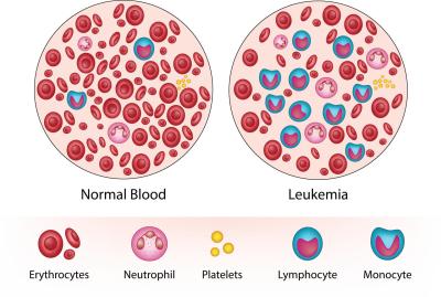 Leukemia Diagnosis and Staging | Herbert Irving Comprehensive Cancer ...