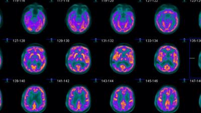 Benjamin Izar, MD, PhD | Herbert Irving Comprehensive Cancer Center ...