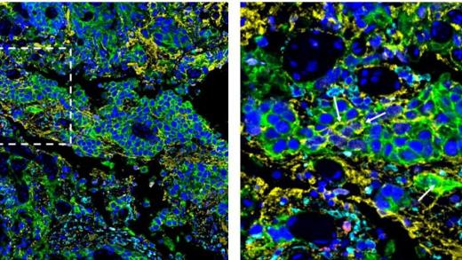 Benjamin Izar, MD, PhD | Herbert Irving Comprehensive Cancer Center ...