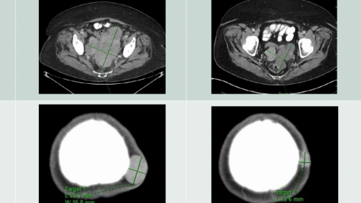 Matthew A. Ingham, MD | Herbert Irving Comprehensive Cancer Center ...