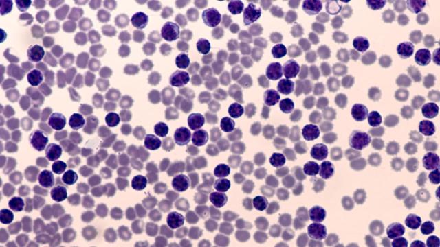 Leukemia Symptoms & Diagnosis | Herbert Irving Comprehensive Cancer ...